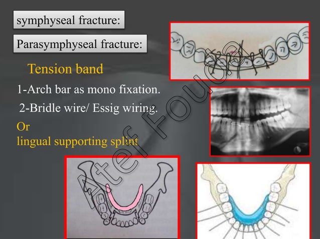 mandibular body,symph. and parasymph. fracture | PPSX | Physical ...