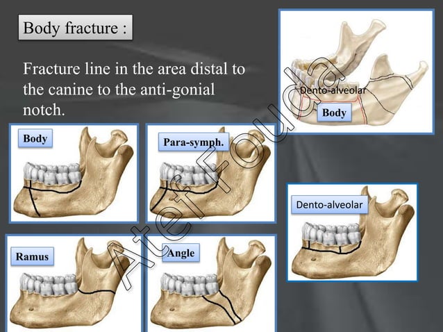 mandibular body,symph. and parasymph. fracture | PPSX | Physical ...