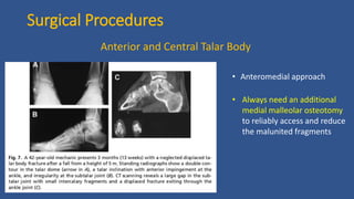 Body talus malunion.pptx