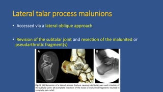 Body talus malunion.pptx