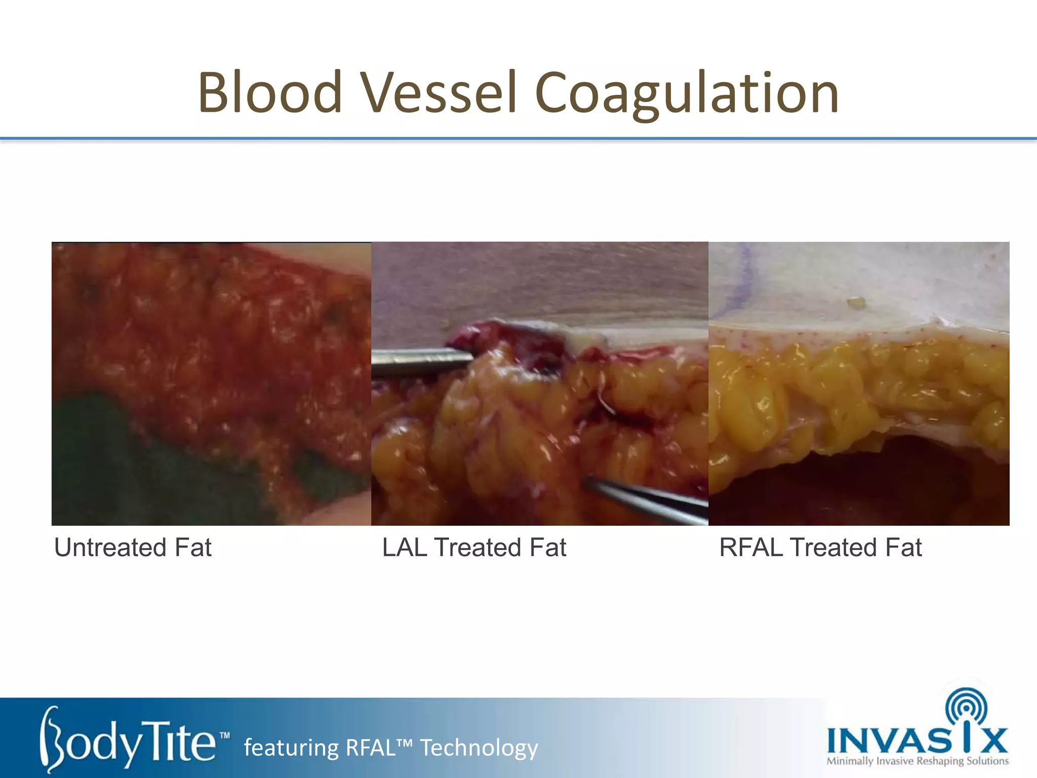 BodyTite™ of Invasix - Presentation | PPT