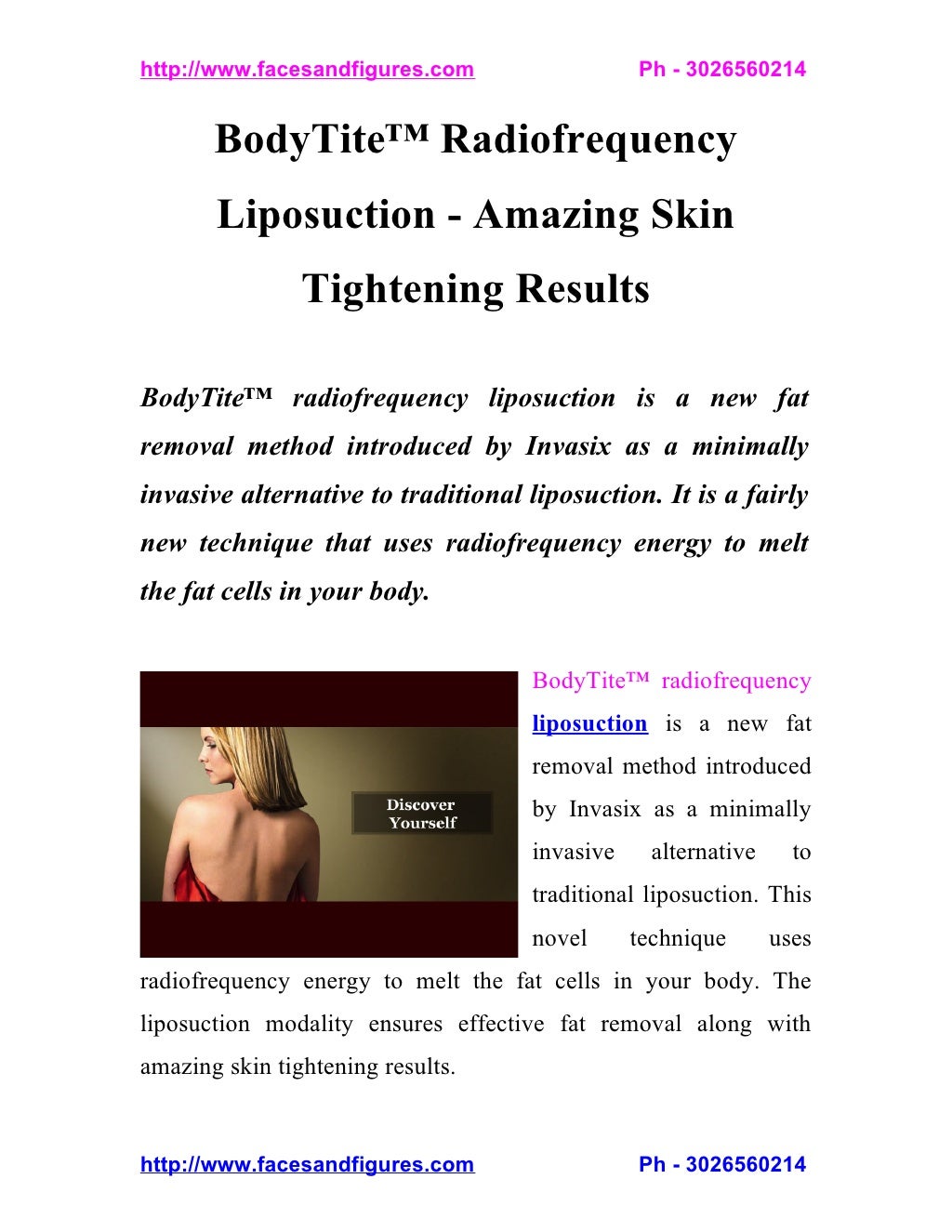 BodyTite Radiofrequency Liposuction - Amazing Skin Tightening Results