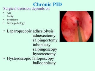 Management of Pelvic Inflammatory Disease (PID) | PPT