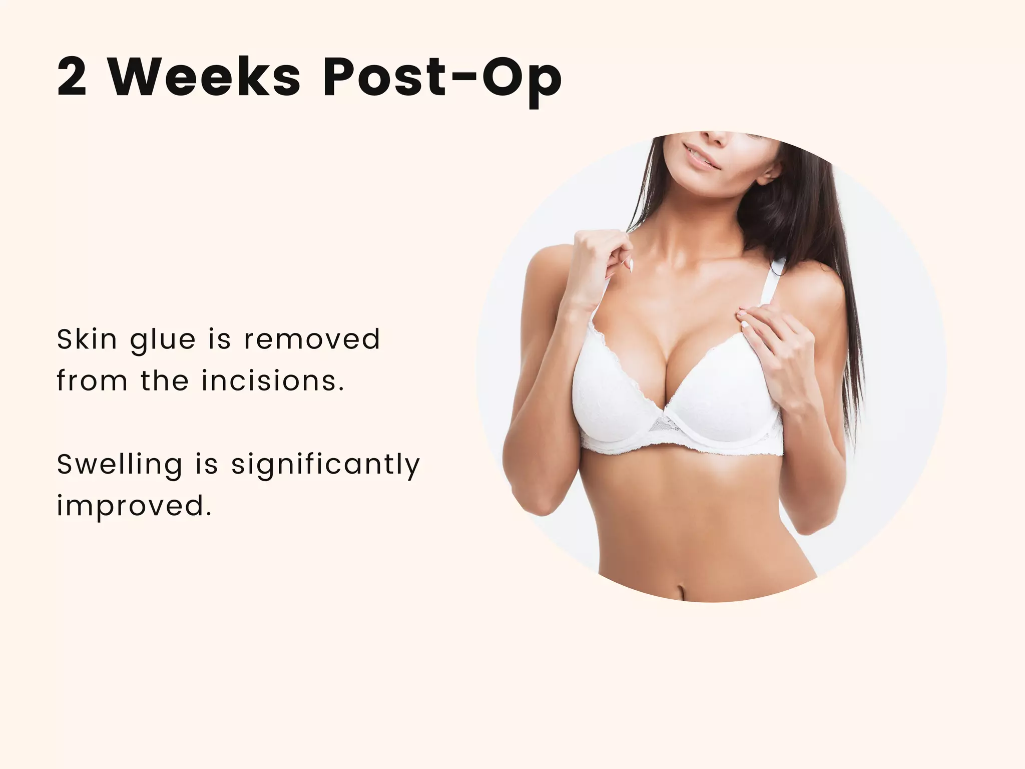 Breast Augmentation Timeline | PDF