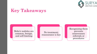Bohn’s Nodules in Newborns - Surya dental care.pptx