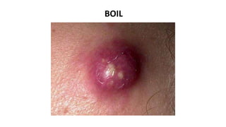 boil abscess.pptx
