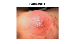 boil abscess.pptx
