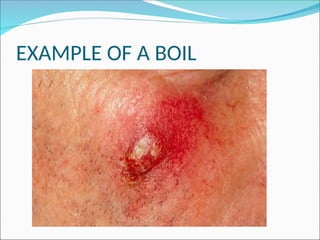 Nursing presentation on Boils and carbuncles.ppt
