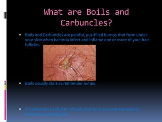 Boils and carbuncles powerpoint | PPTX