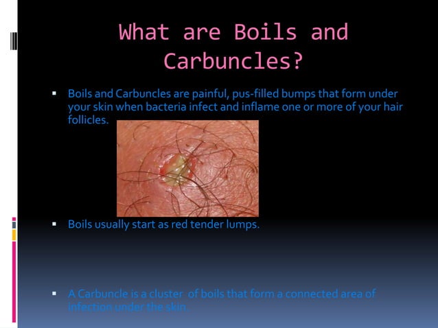 Boils and carbuncles powerpoint | PPTX