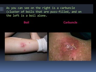 Boils and carbuncles powerpoint | PPTX