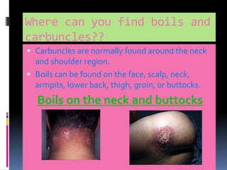 Boils and carbuncles powerpoint | PPTX