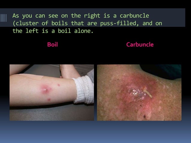 boils and carbuncles powerpoint.pptx | Skin and Dermatology | Diseases ...