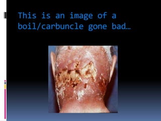 boils and carbuncles powerpoint.pptx