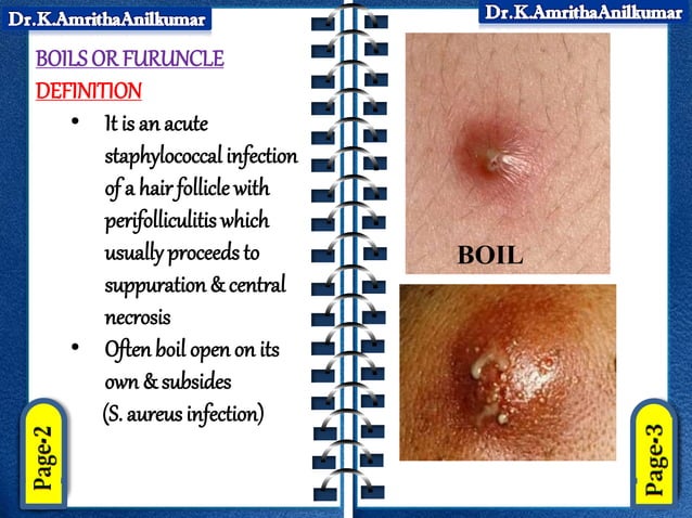 Boils or furuncle by Dr.K.AmrithaAnilkumar | PPTX