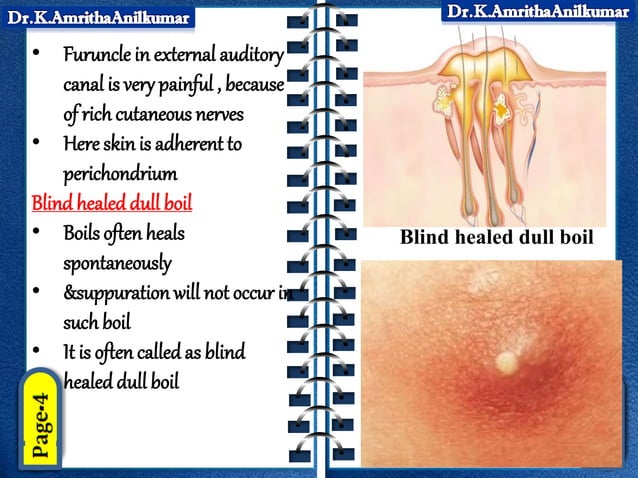 Boils or furuncle by Dr.K.AmrithaAnilkumar | PPTX