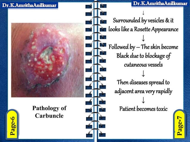 Boils or furuncle by Dr.K.AmrithaAnilkumar