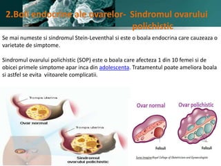 Boli endocrine ale ovarelor | PPT