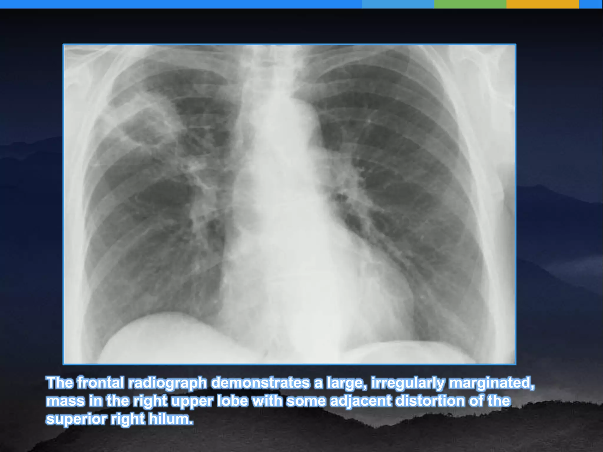 diagnostic workup of the the thoracic surgery patient | PPTX