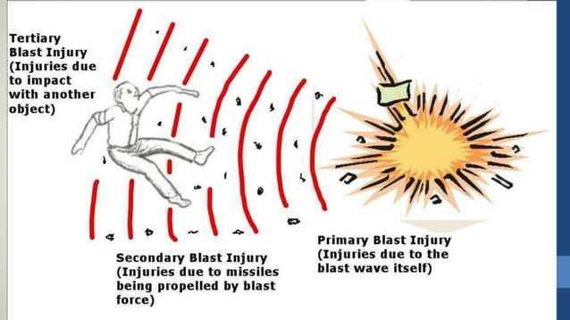 BOMB BLAST INJURIES.pptx