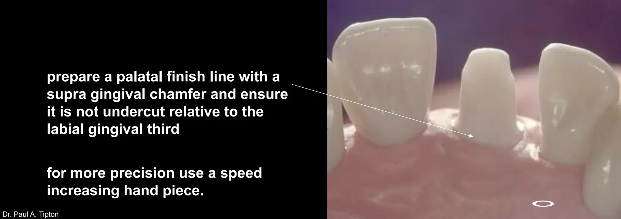 Tooth Preparation - Anterior bonded crowns | PDF