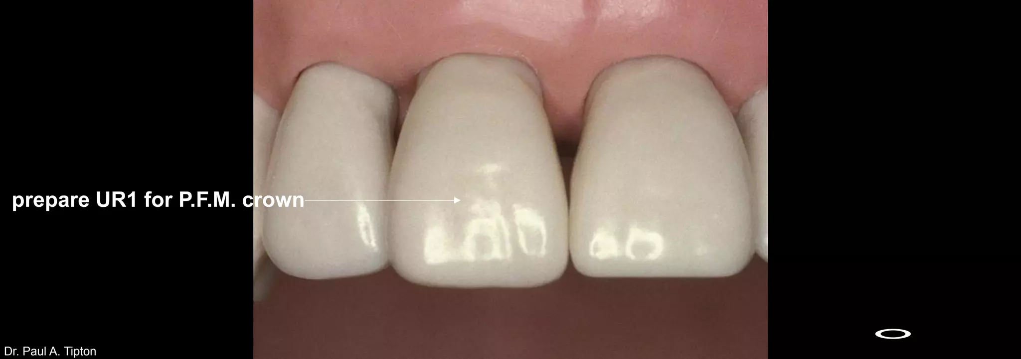 Tooth Preparation - Anterior bonded crowns | PDF