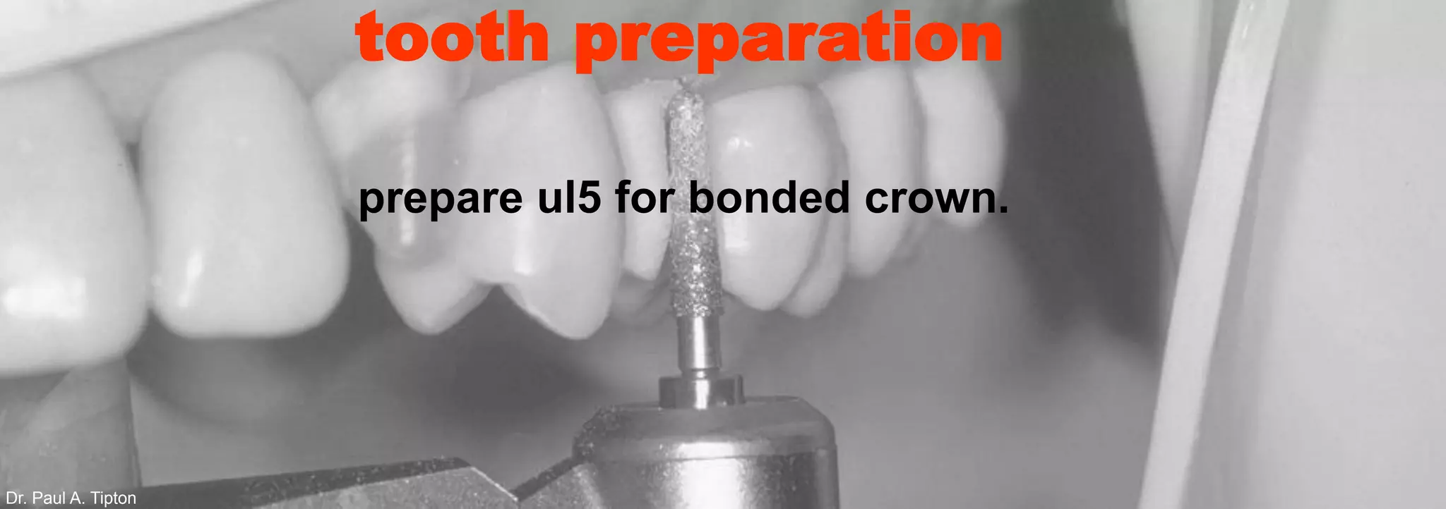 Tooth Preparation - Anterior bonded crowns | PDF