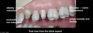Tooth Preparation - Anterior bonded crowns | PDF