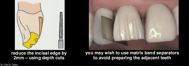 Tooth Preparation - Anterior bonded crowns