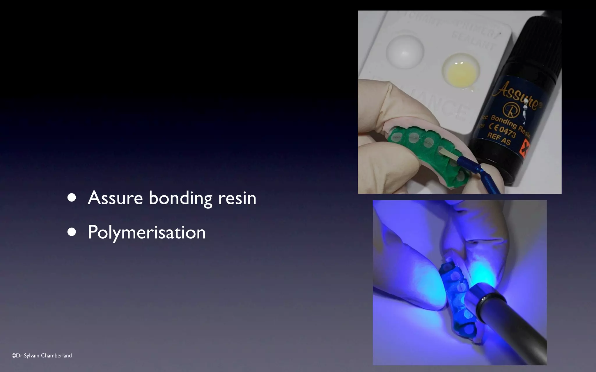 Bonded lingual retainer | KEY