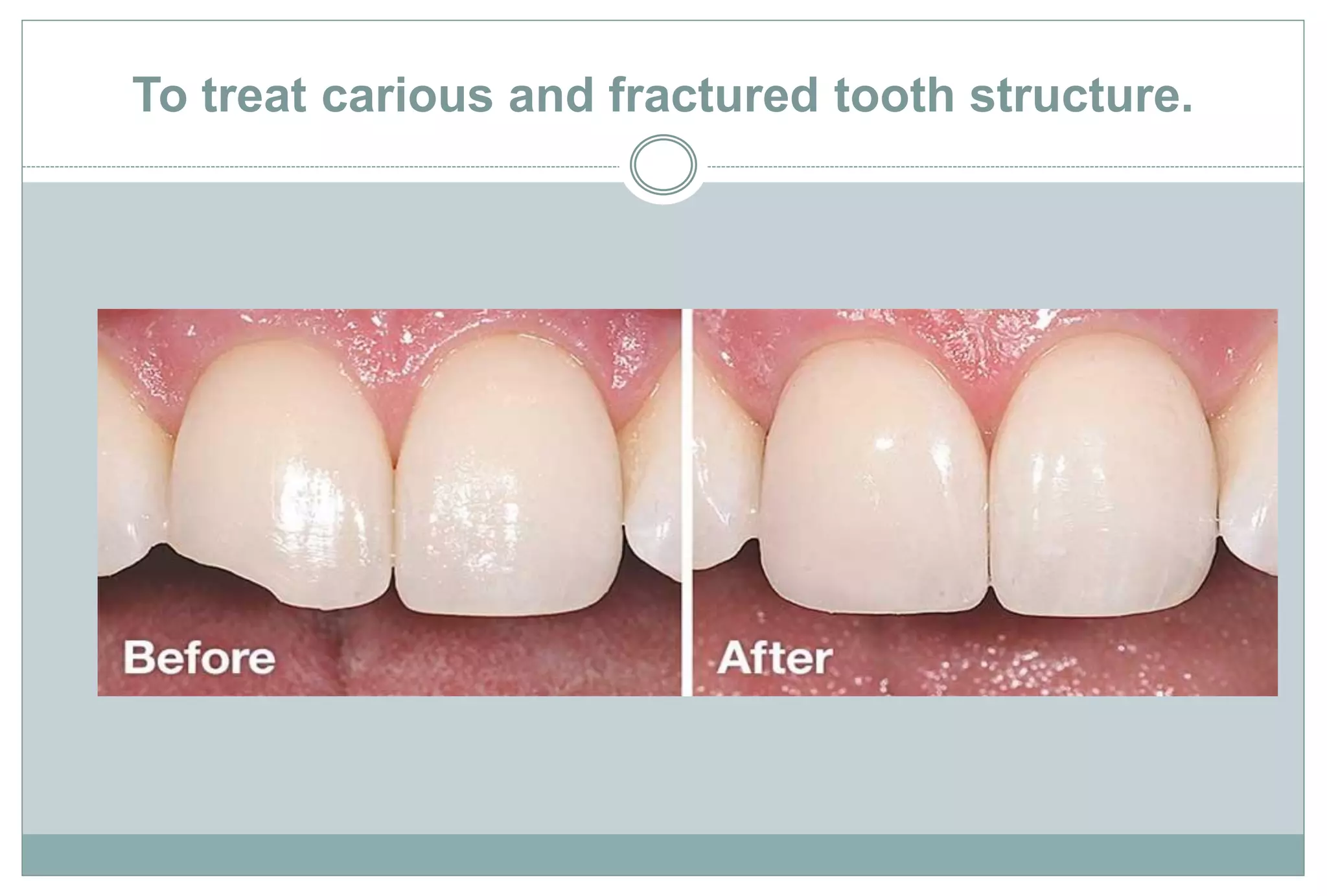 Adhesion and Dentin Bonding agent | PDF