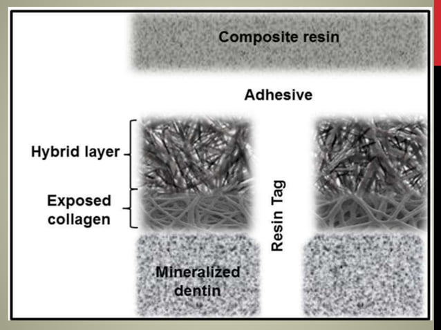Dentin Bonding agents generations | PPTX | Dental Health | Diseases and ...