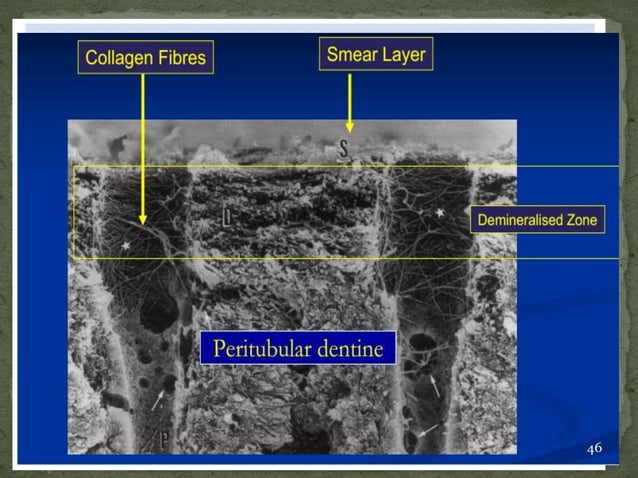 Bonding agents used in dentistry | PPTX