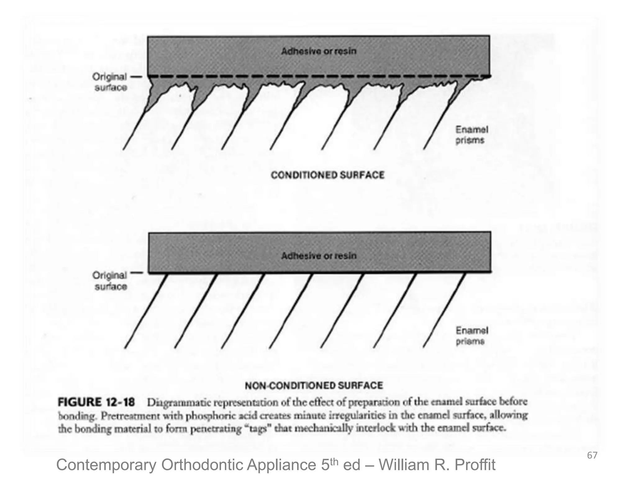 Bonding in Orthodontics | PPTX