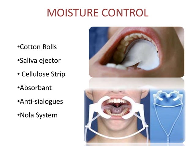 Bonding in Orthodontics | PPTX | Dental Health | Diseases and Conditions