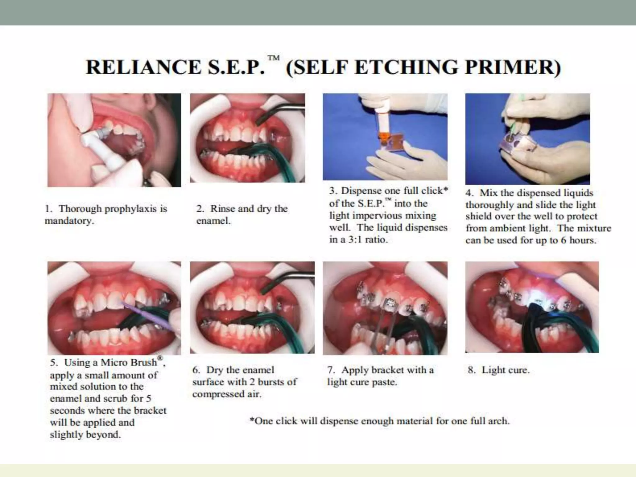 Bonding in orthodontics | PPTX