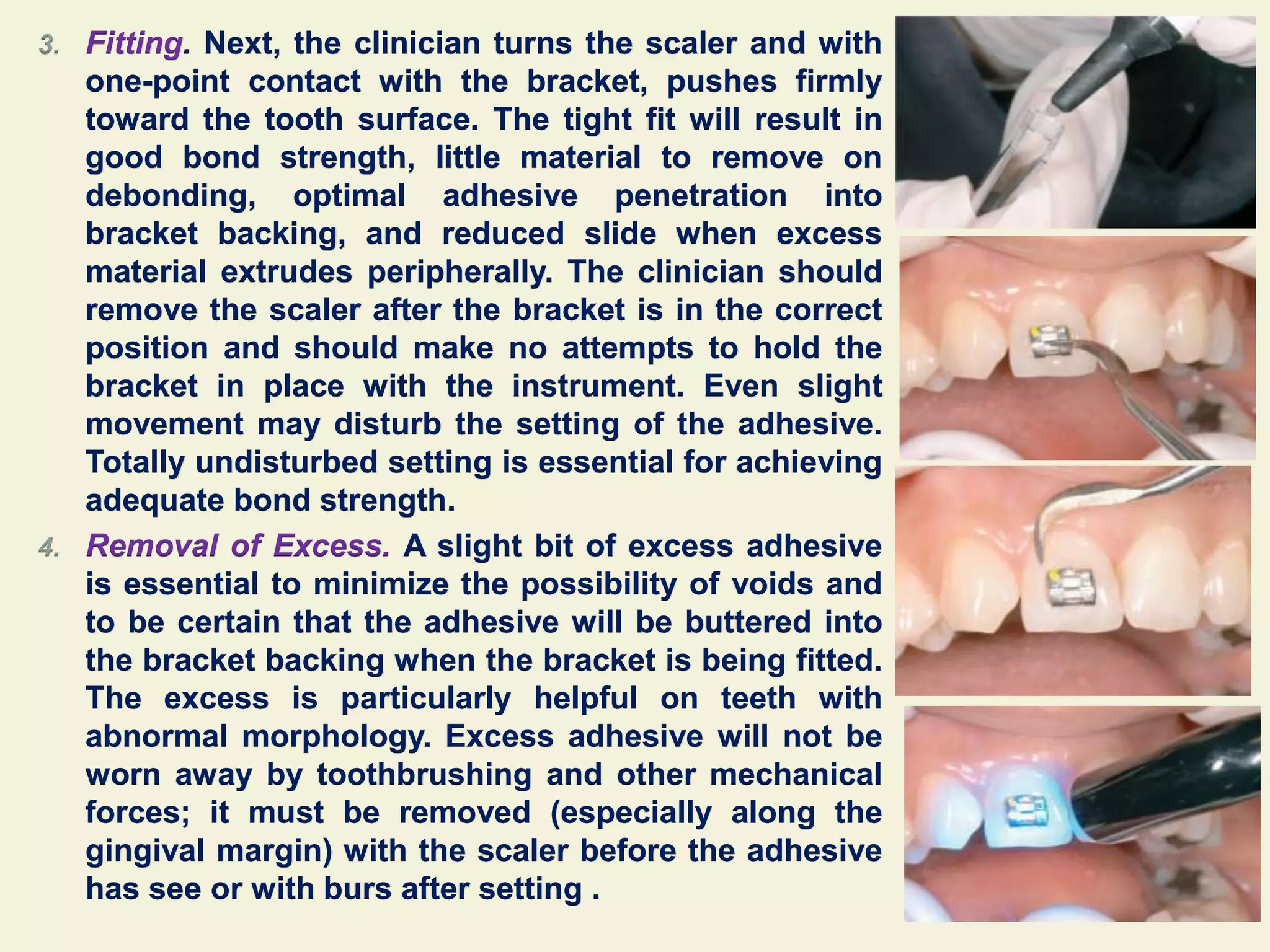 Bonding in orthodontics | PPTX