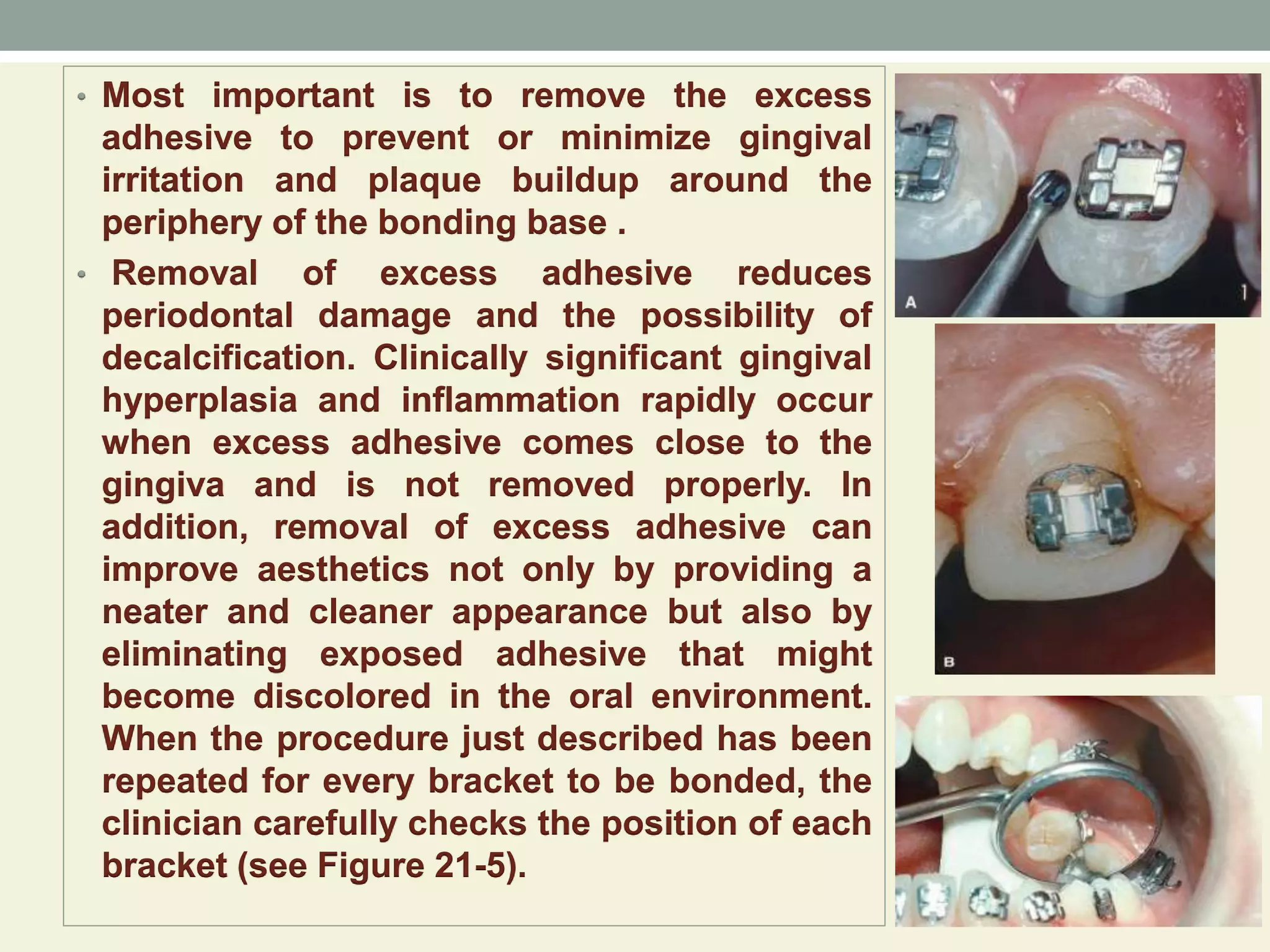 Bonding in orthodontics | PPTX