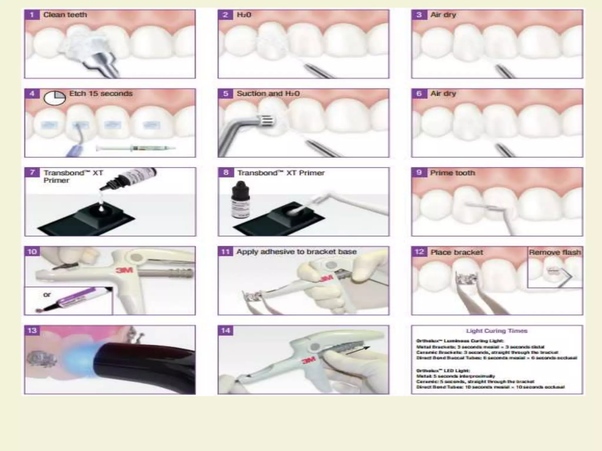 Bonding in orthodontics | PPTX