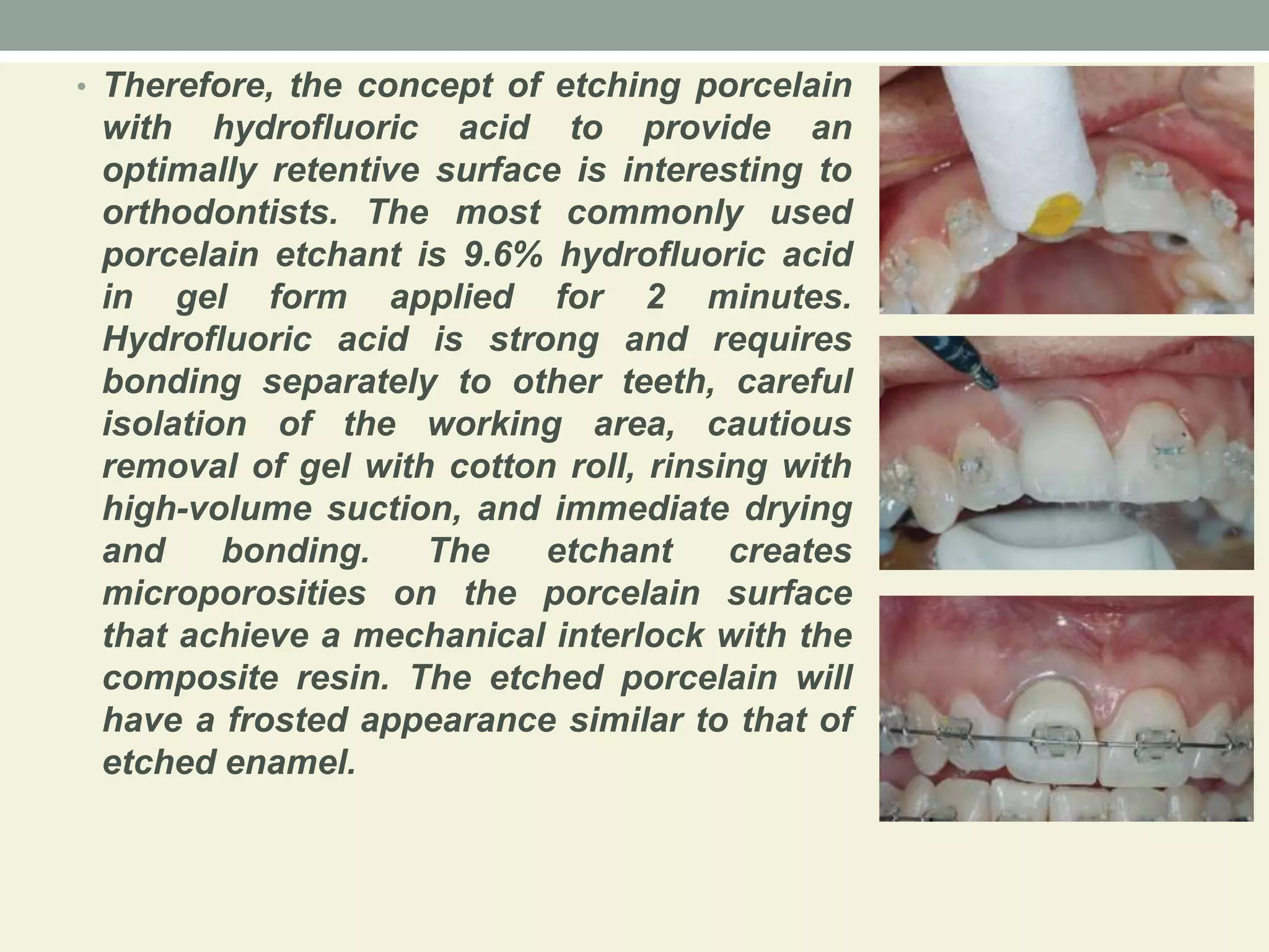 Bonding in orthodontics | PPTX