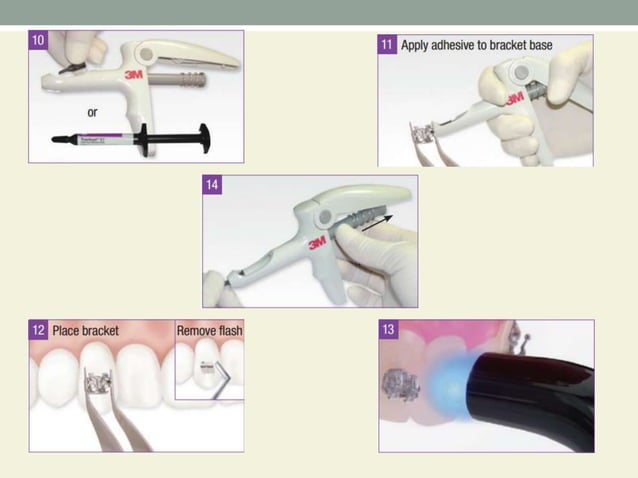 Bonding in orthodontics | PPTX