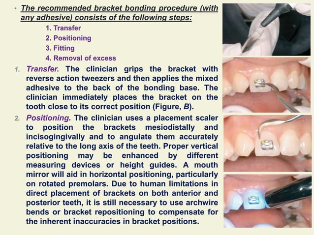 Bonding in orthodontics | PPTX