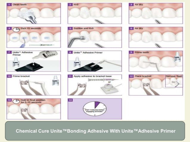 Bonding in orthodontics | PPTX
