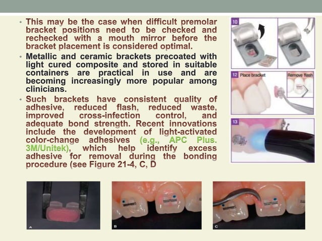Bonding in orthodontics | PPTX