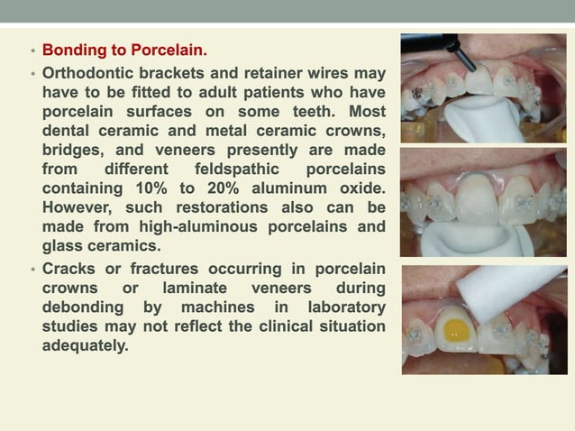 Bonding in orthodontics | PPT