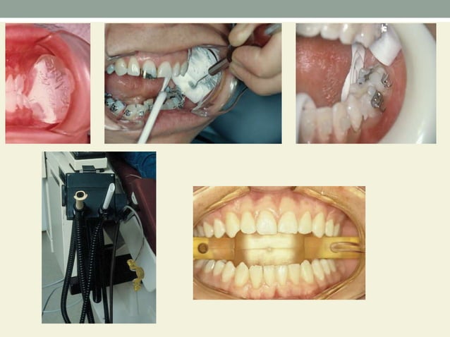 Bonding in orthodontics | PPTX