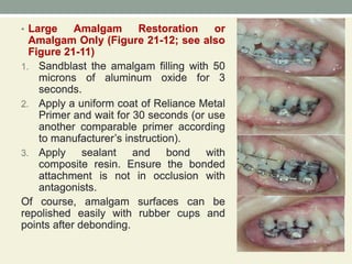 Bonding in orthodontics | PPTX