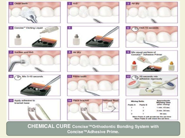 Bonding in orthodontics
