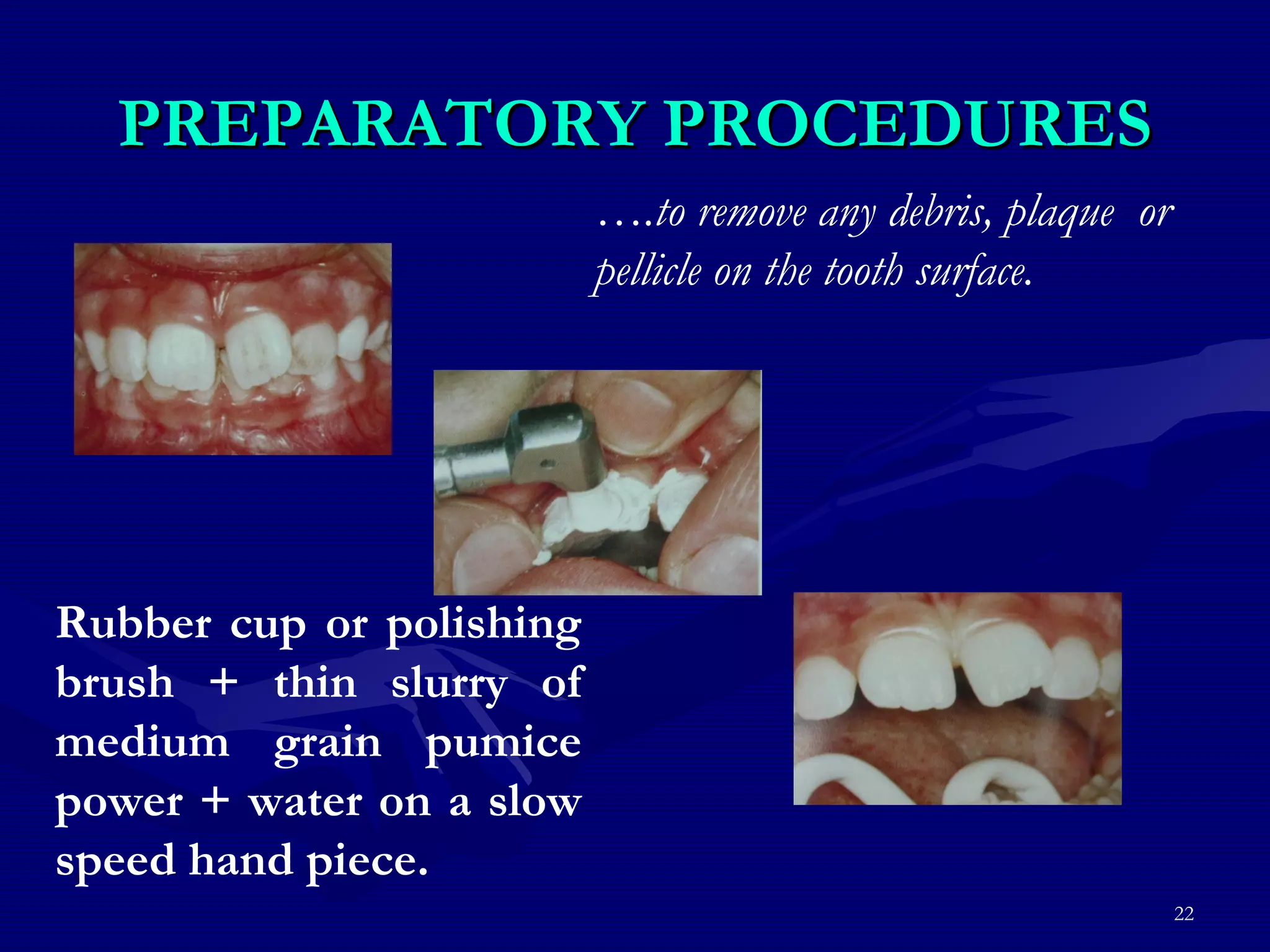 Bonding in orthodontics | PPT