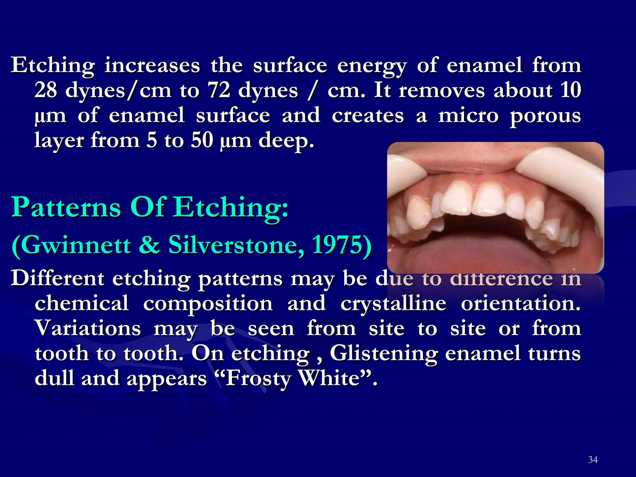 Bonding in orthodontics | PPT